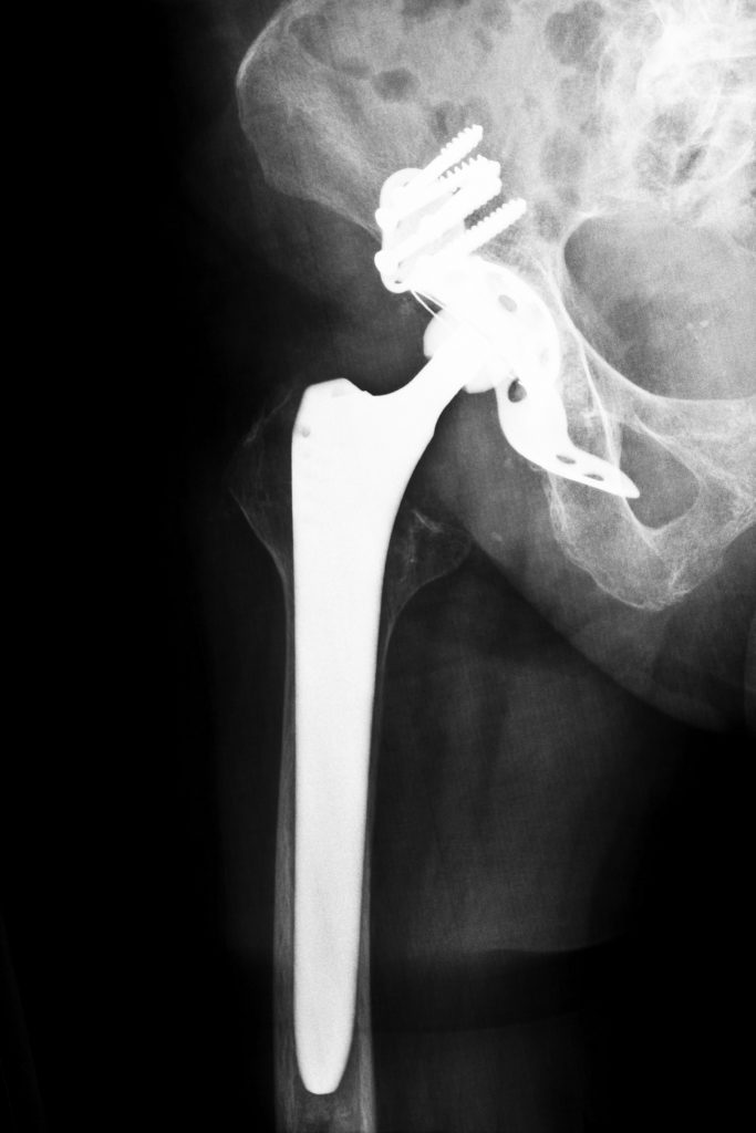 Metal on Metal Hip | Johnson Firm